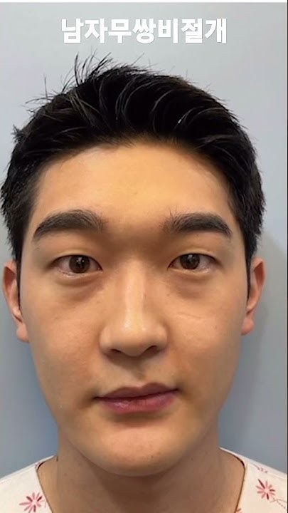 남자속쌍 남자무쌍 남자비절개눈수술 남자눈수술 남성전문 무통수면마취 무쌍 쿨성형외과 이지앤성형외과 김동규원장님 💙 Youtube