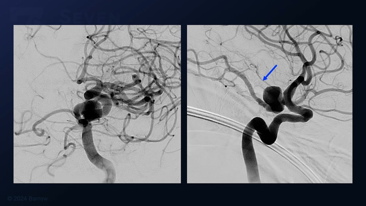 Pterional Craniotomy for Clipping of a Dolichoectatic Thrombotic Fetal ...