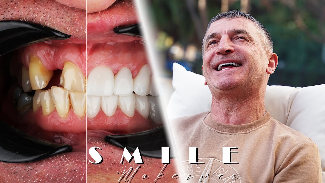Full Smile Makeover / Testimonial - YouTube