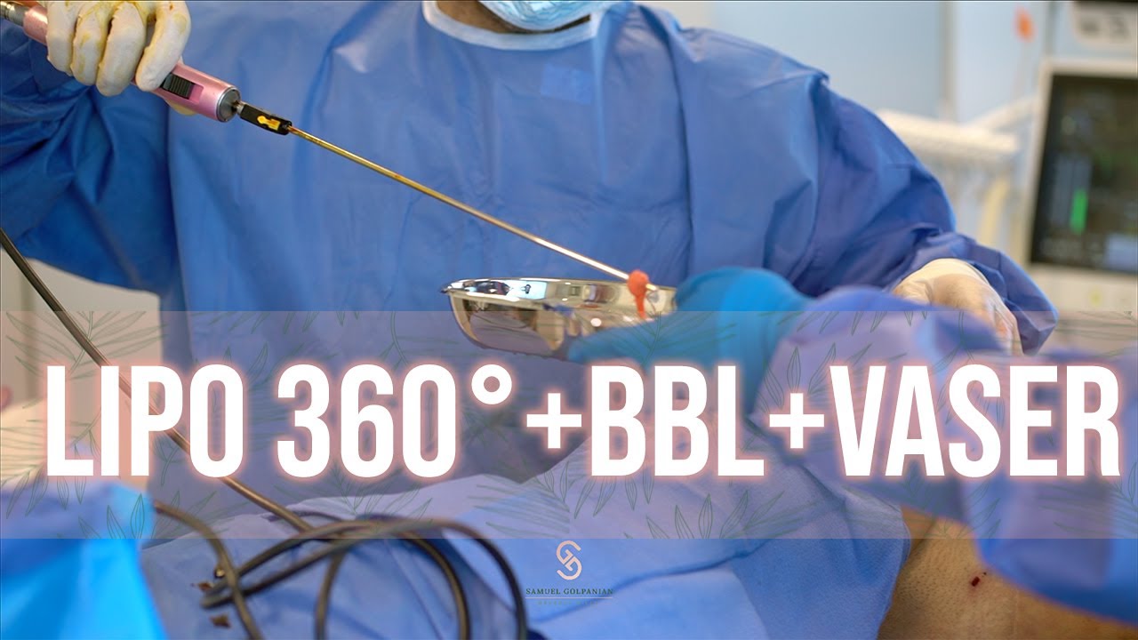 BBL + LIPO 360 + VASER - YouTube