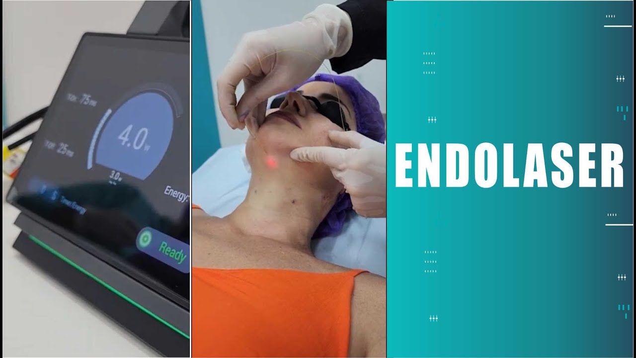 NOVIDADE EM RIO BRANCO - ENDOLASER - YouTube