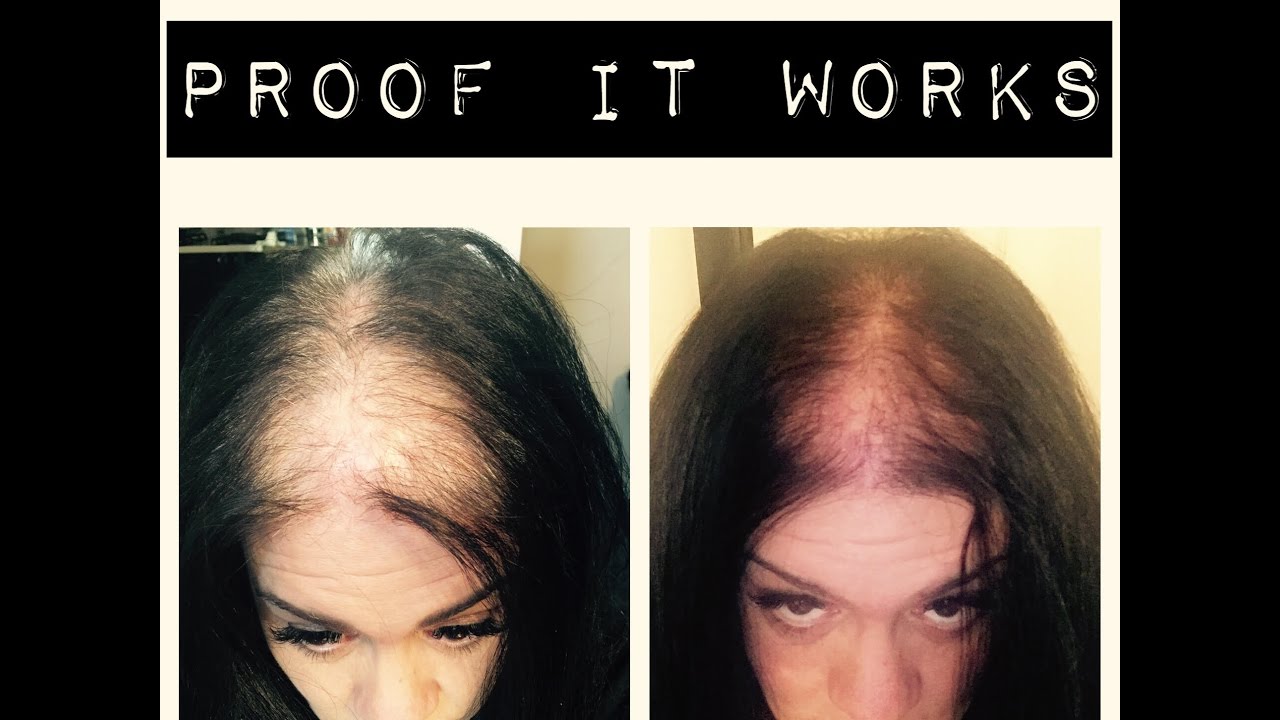 Thin And bald Hair challenge | PICTURE PROOF IT WORKS YAY!!!!!! - YouTube