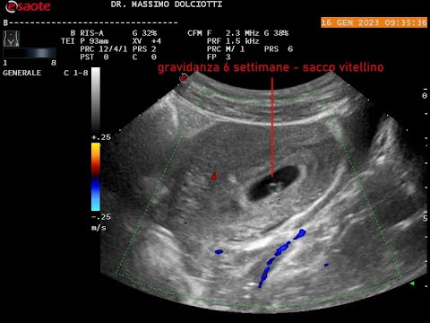 gravidanza alla 6° settimana di gestazione - YouTube