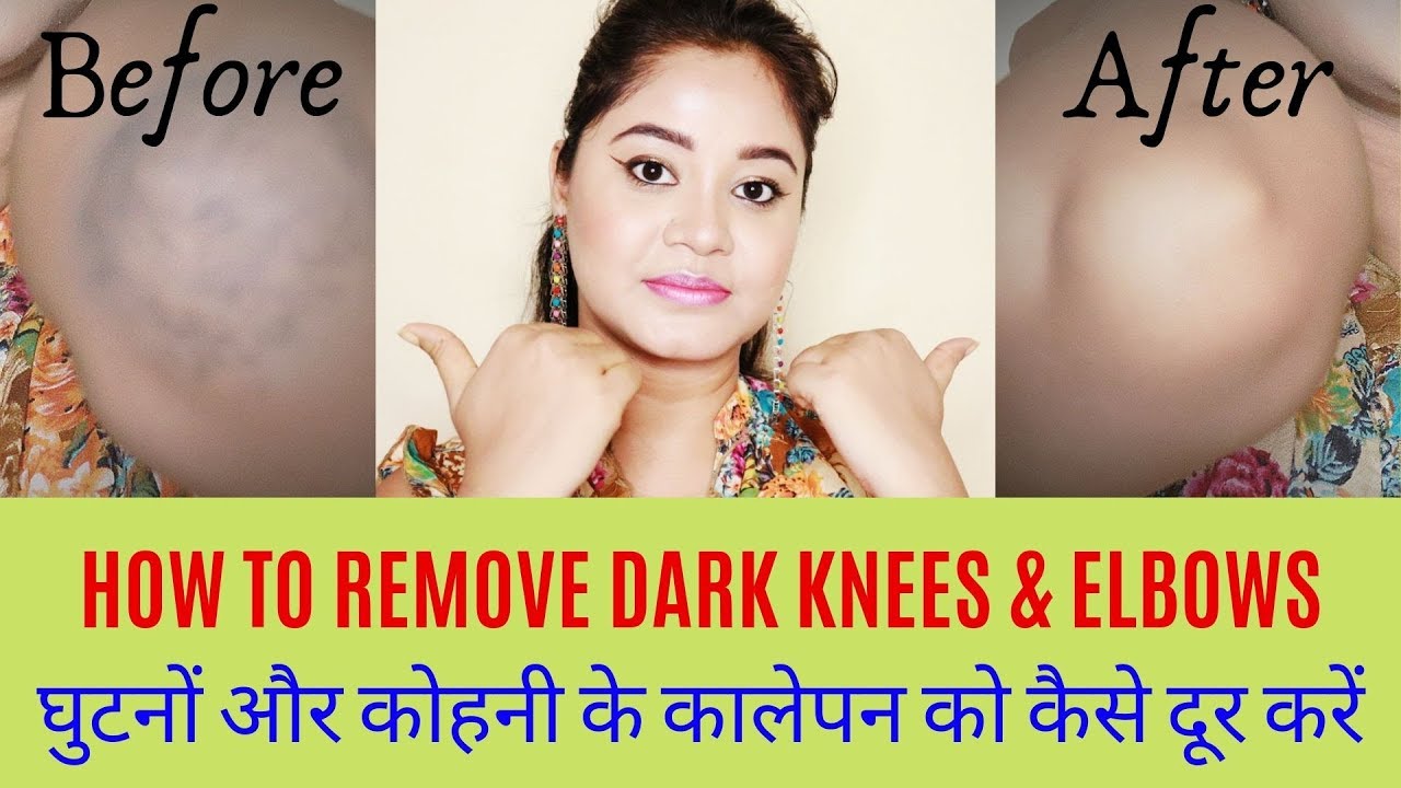 HOW TO REMOVE DARK KNEES AND ELBOWS | FASHION & ME - YouTube