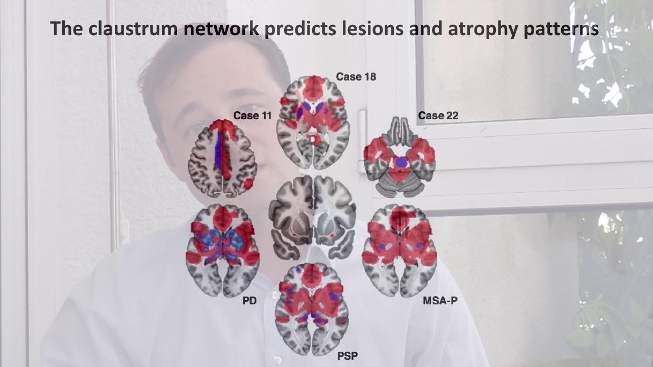 Localizing parkinsonism based on focal brain lesions - YouTube