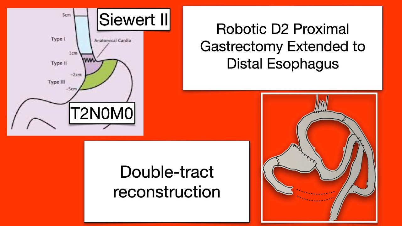 Robotic D2 Proximal Gastrectomy Extended to Distal Esophagus and Double ...