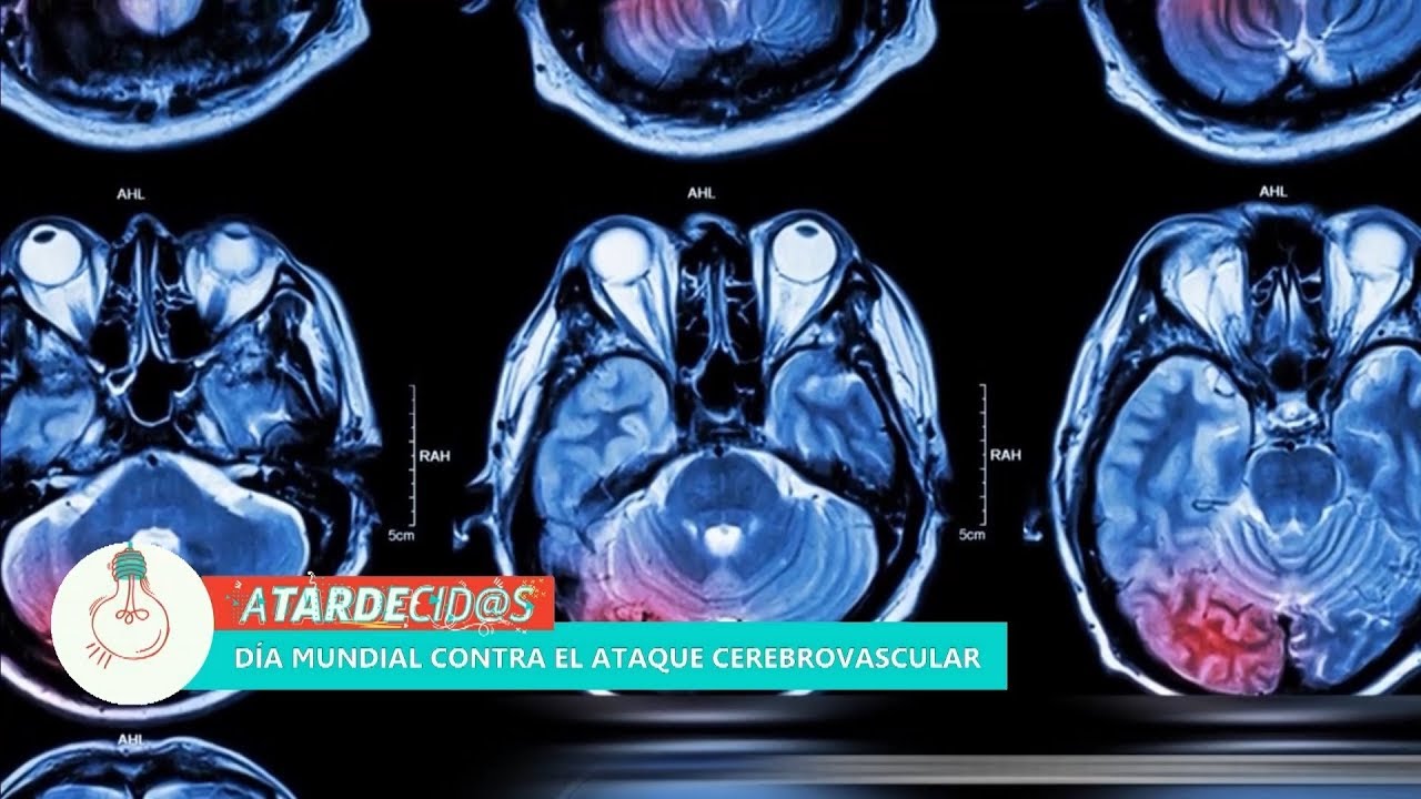 Cuáles son los síntomas y cómo actuar ante un ACV - YouTube