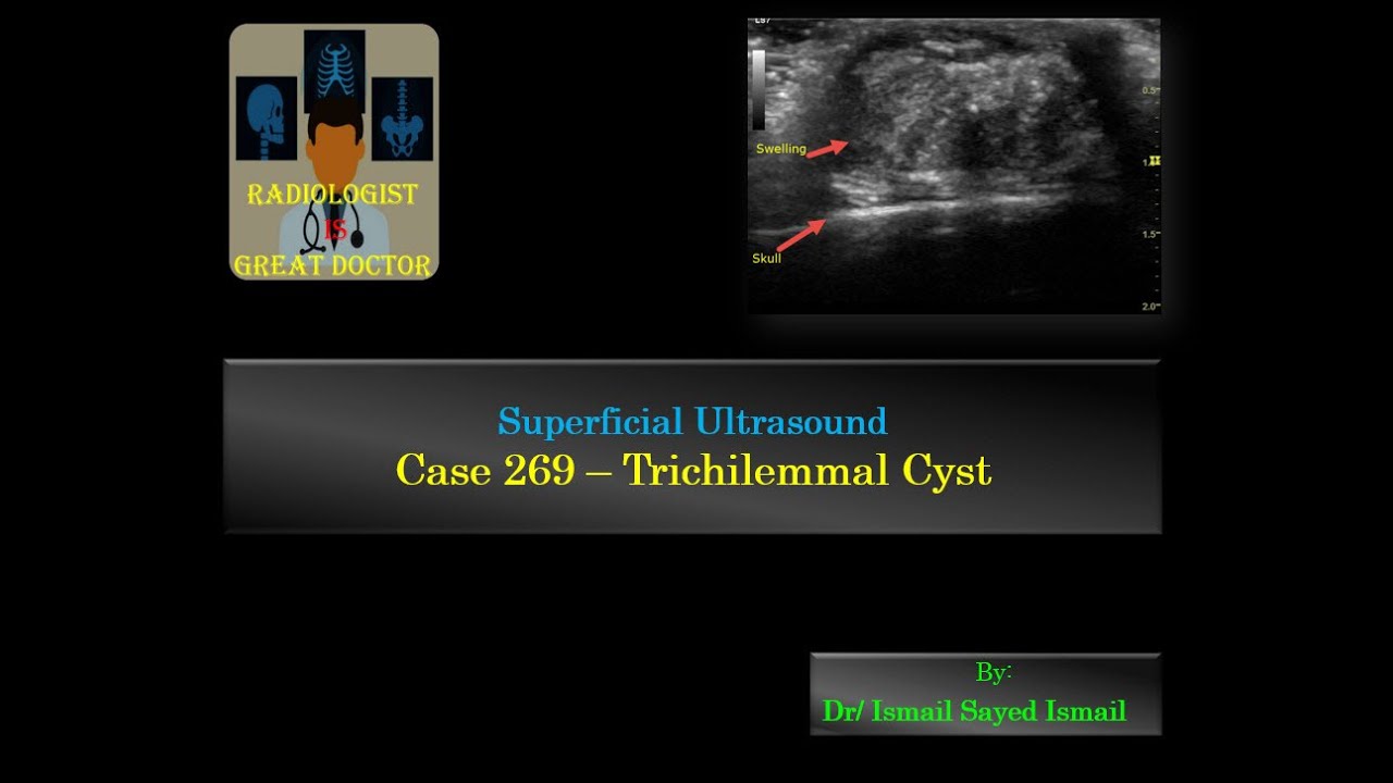 Ultrasound Case 269 - Trichilemmal Cyst - YouTube