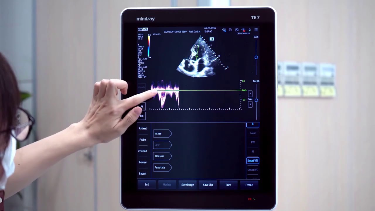 Mindray TE7 ACE Smart VTI - YouTube