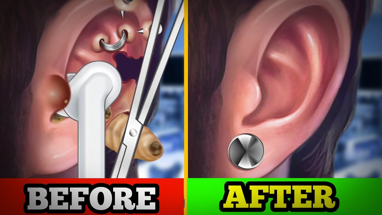 ASMR remove worm & maggot ear infected🐛🐛 #asmr #shorts #viral #gaming ...