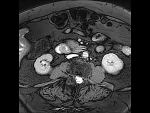 Ampullary carcinoma - YouTube
