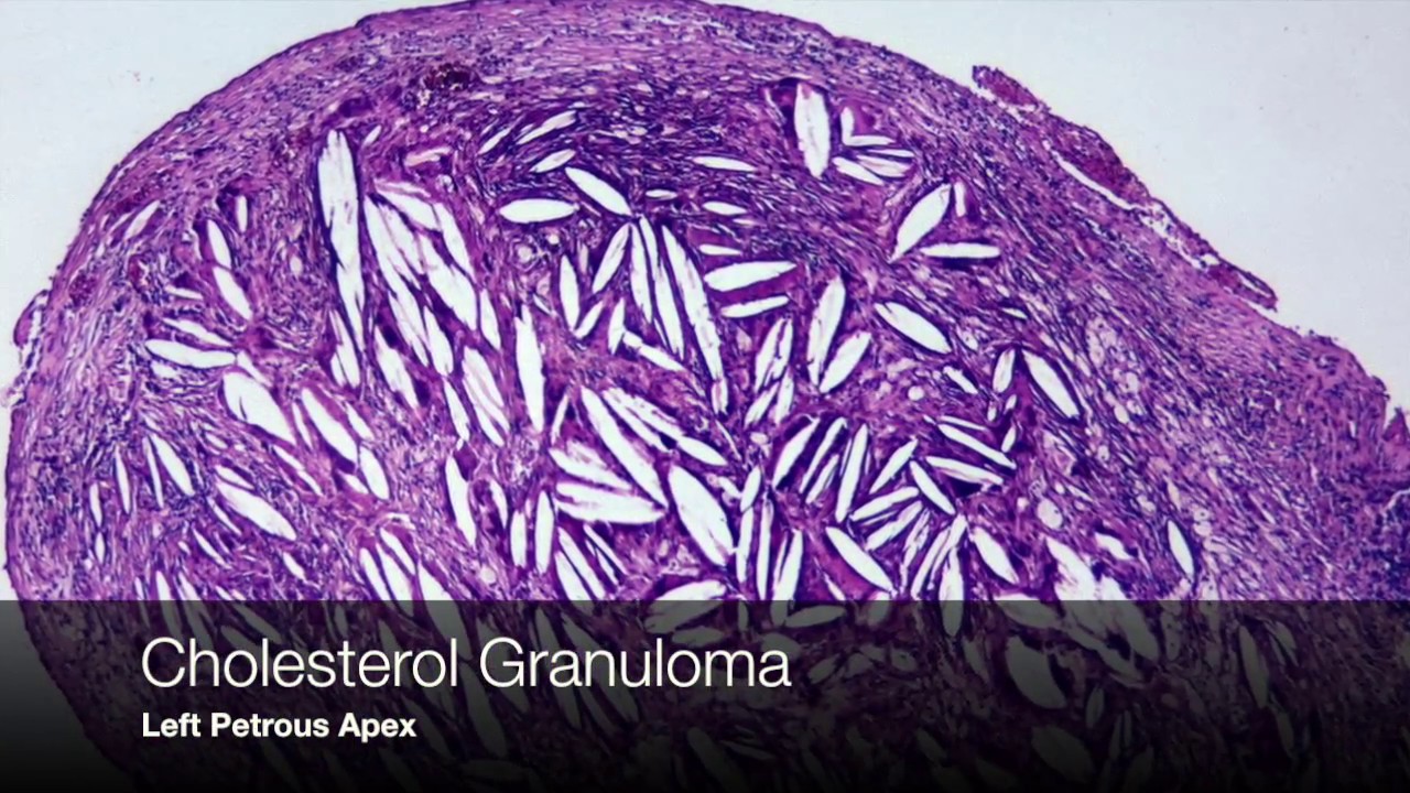 Infracochlear Approach to A Petrous Apex Lesion - YouTube