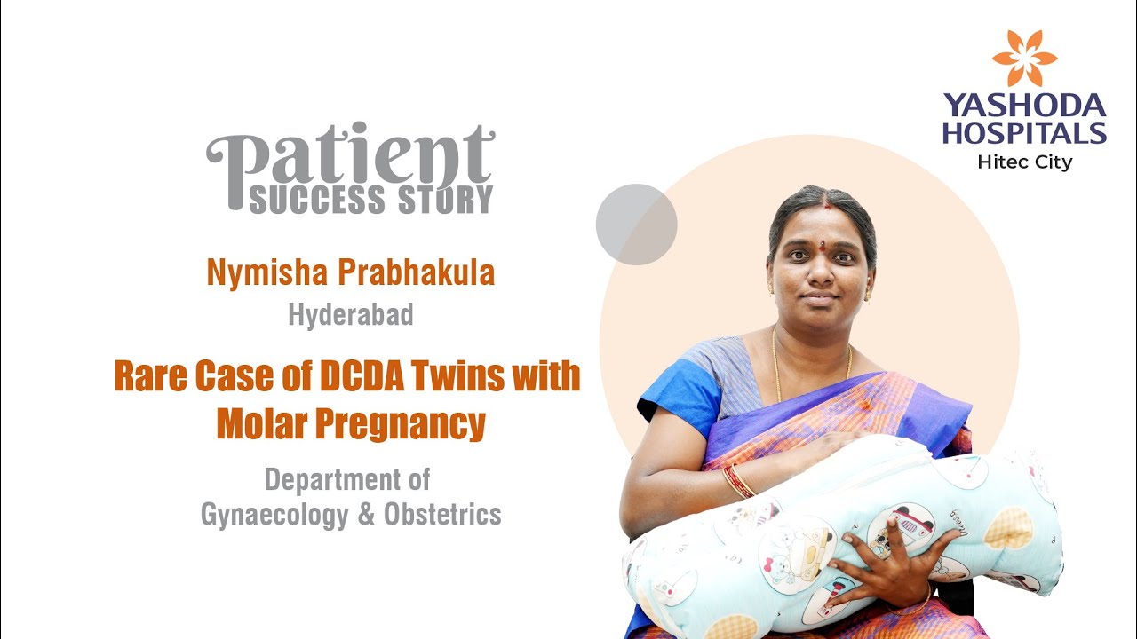 Rare Case of DCDA Twins with Molar Pregnancy | Yashoda Hospitals ...