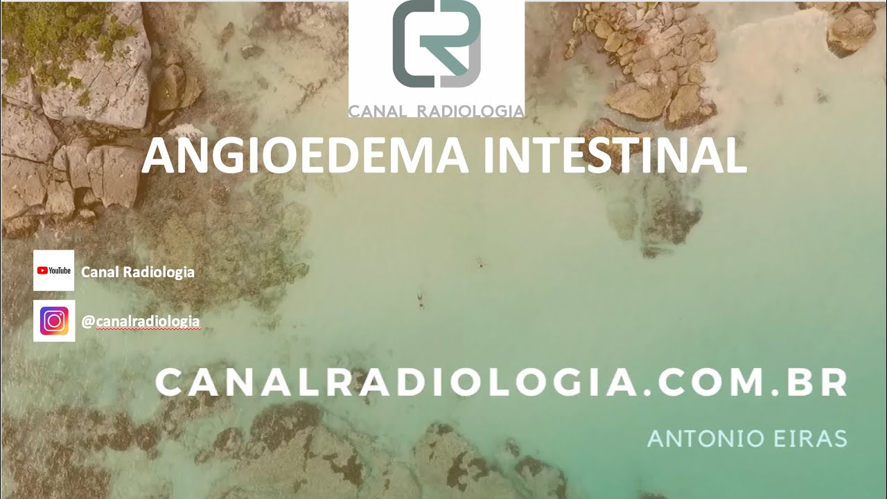 Angioedema Intestinal - YouTube