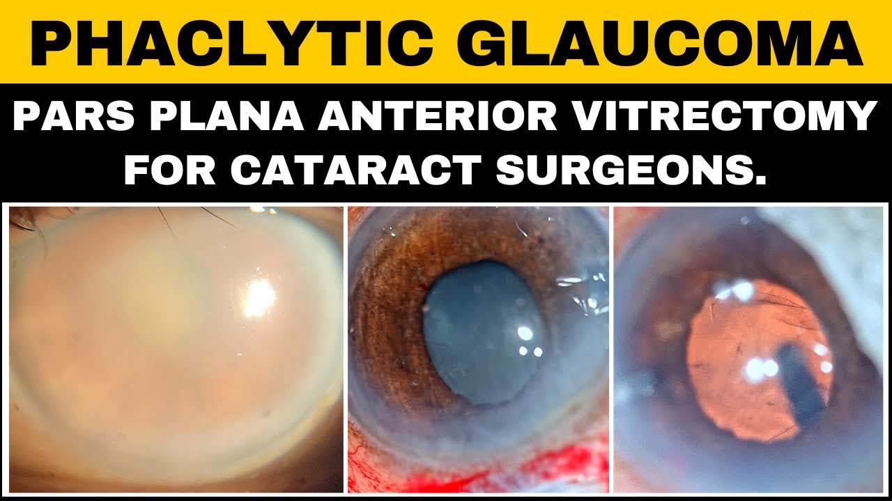 Interesting Finding - Lens Matter in Berger's Space. Pars Plana ...