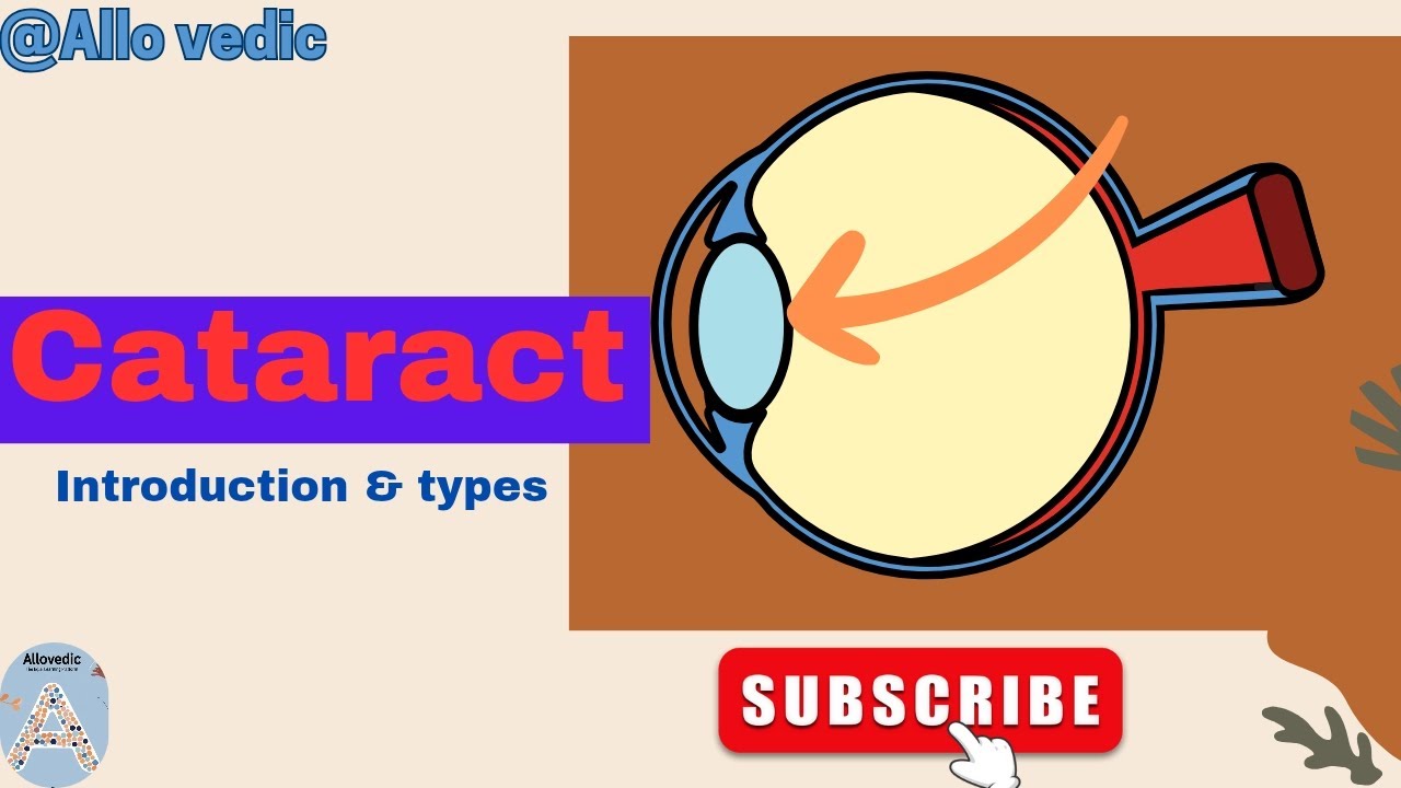 CATARACT - introduction & types #eyediseases #cataract #mbbs - YouTube