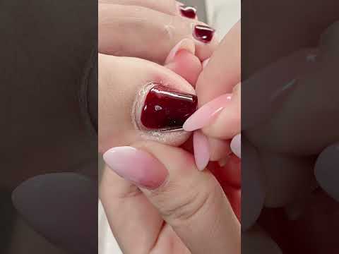 Lấy khoé móng chân quặp thịt siêu phê! 