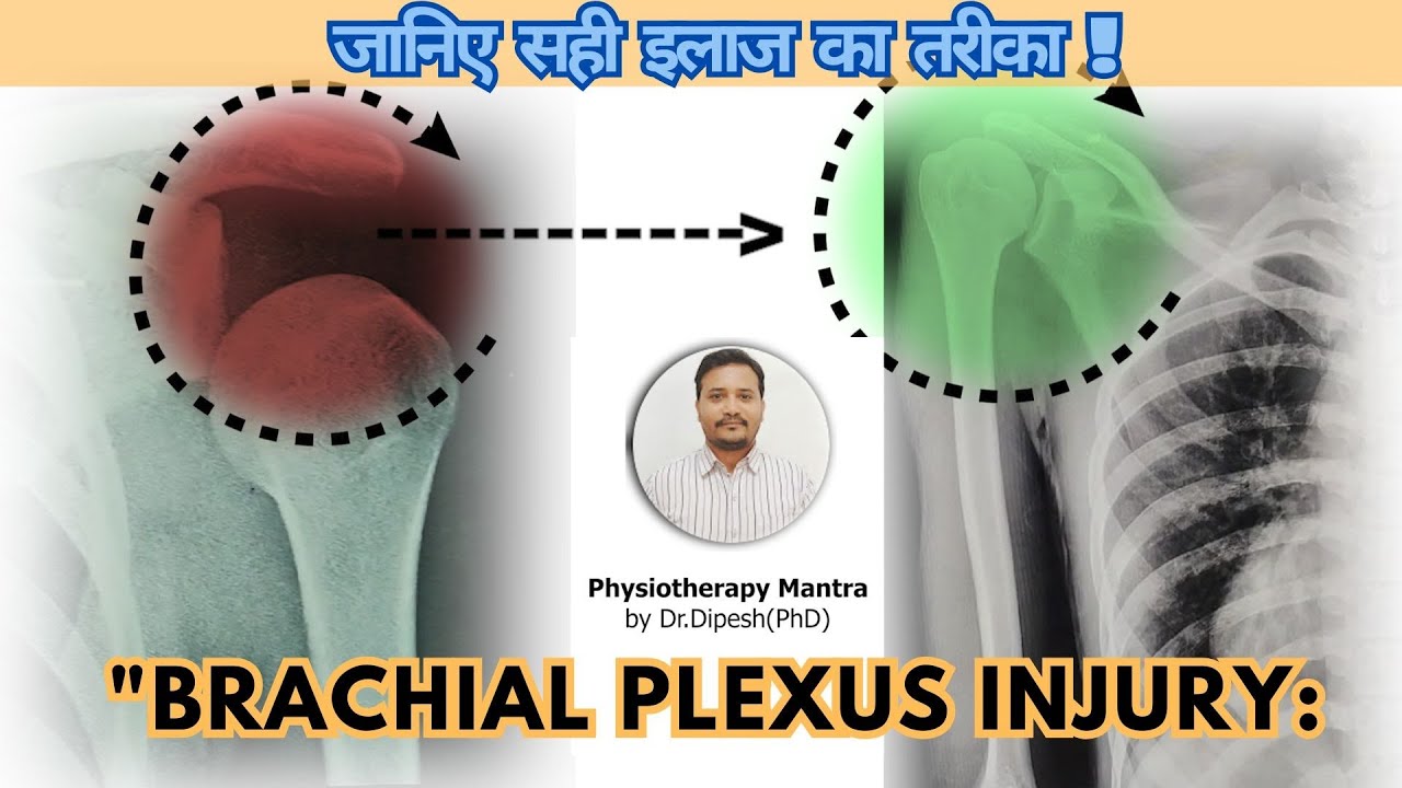 Brachial plexus injury with shoulder sulcus #physiotherapy #nerve repair #nerve transfer #ms # ...