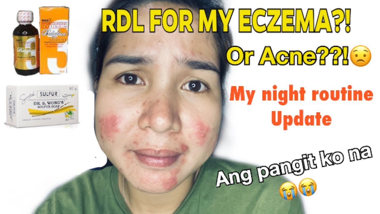 RDL BABYFACE #3 for my Ezcema Or Acne?? | NIGHT ROUTINE - YouTube