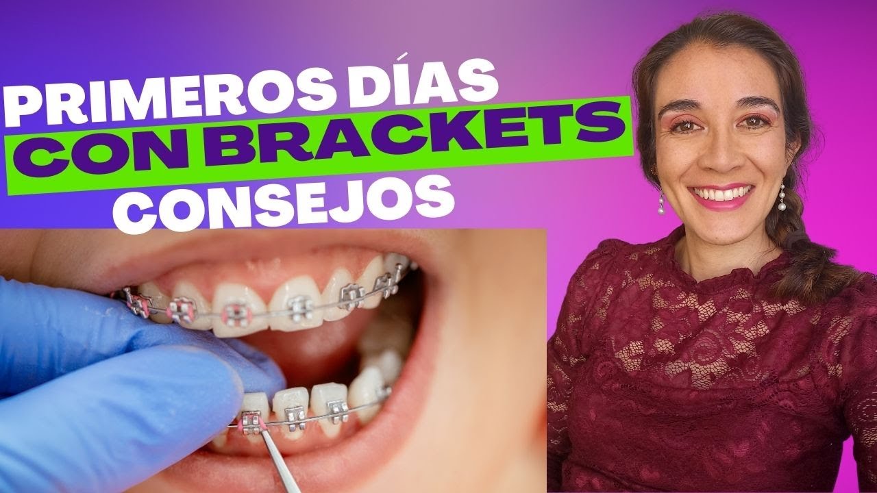 Consejos para los Primero Días con BRACKETS - YouTube