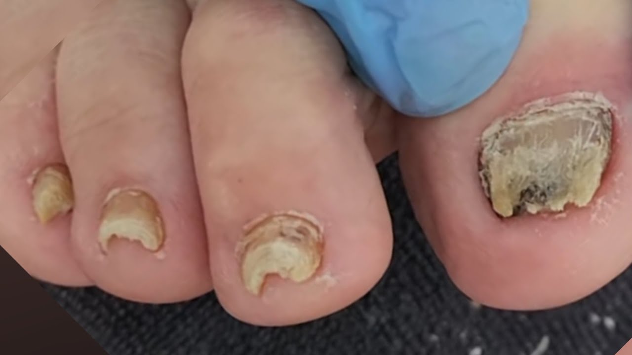 Halos lahat ng kuko nabulok dahil sa sakit na fungus - YouTube