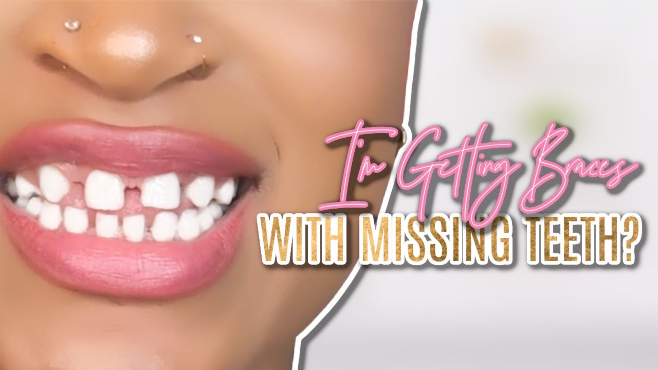 I'M GETTING BRACES WITH MISSING TEETH? - VERY INFORMATIVE - YouTube