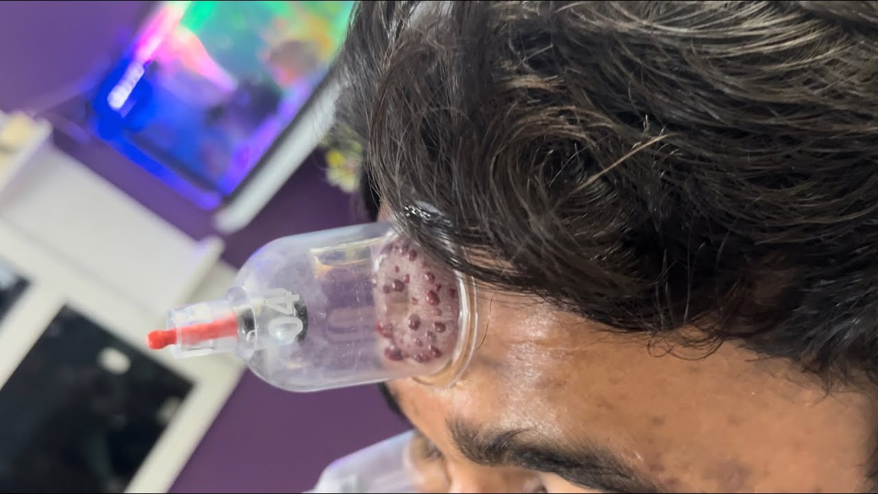 Hijama Therapy(Cupping therapy)for pimples on face.#cuppingtherapy # ...
