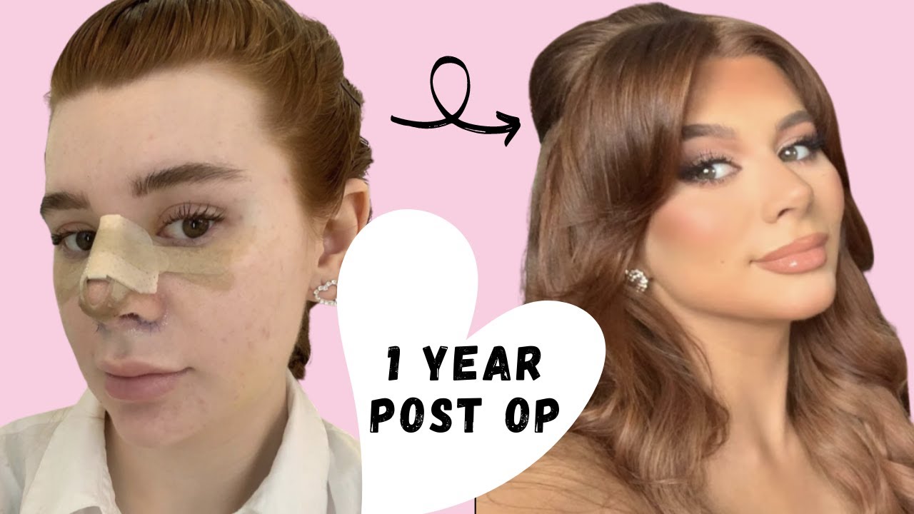 1 YEAR NOSE JOB POST OP | Antonia Higham - YouTube