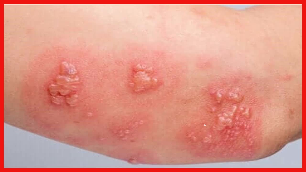 Pemphigoïde bulleuse : symptômes, causes et traitement - YouTube