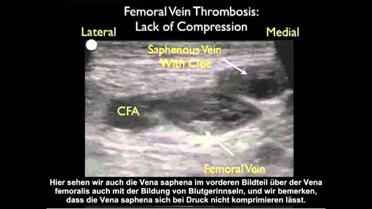 Anleitung: Fallstudie – Ermittlung einer tiefen Venenthrombose mit ...