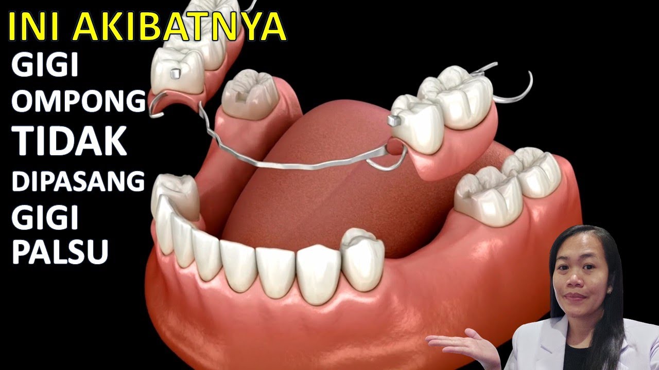 Ini akibatnya terlalu lama membiarkan gigi ompong tidak dipasang gigi palsu ! - YouTube