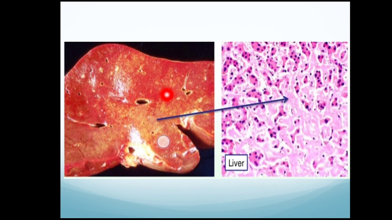 AMYLOIDOSIS PATHOLOGY-2 Robbins 10th ed, for med UG/PG - YouTube