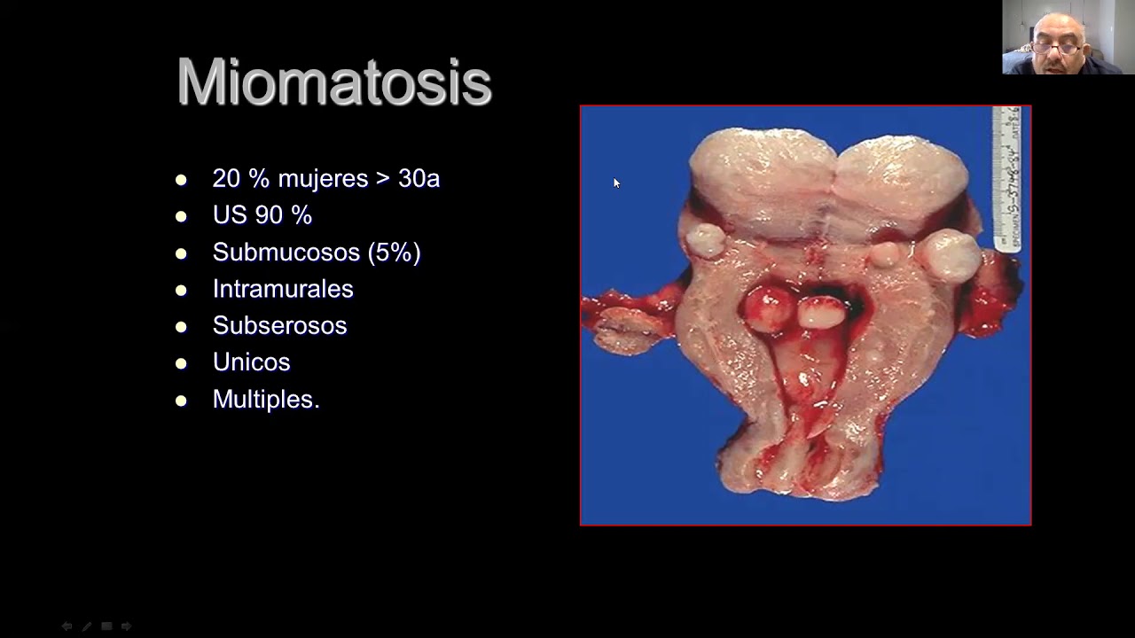 GINECO 1a parte - YouTube