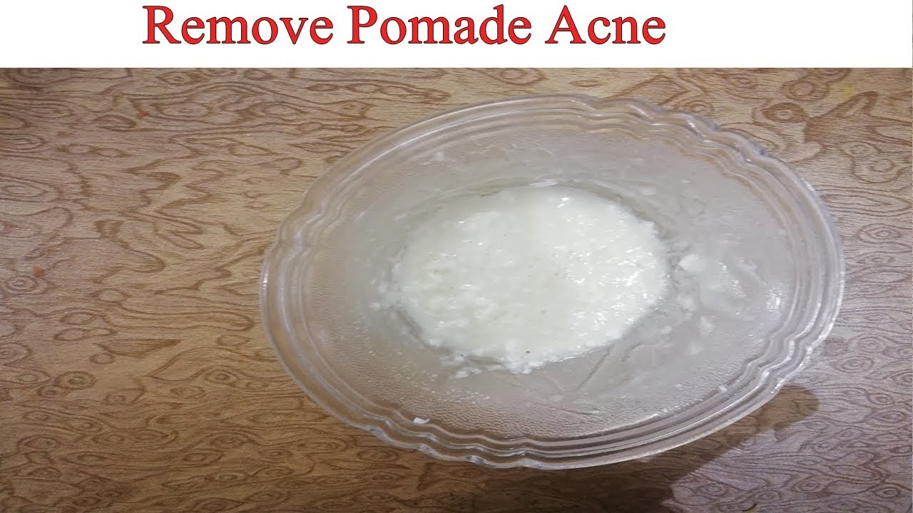 How To Remove Pimples In 5 Minutes - How To Remove Pimples Overnight ...