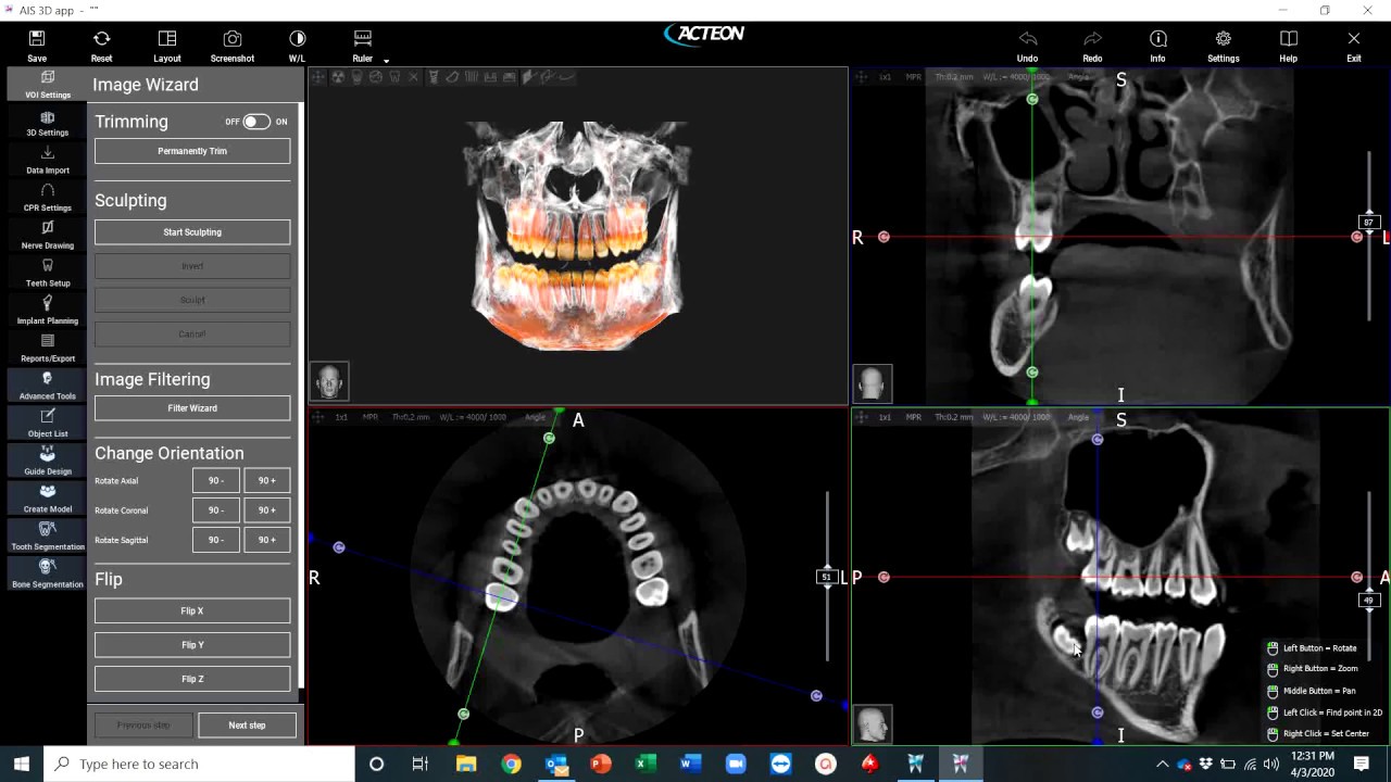 3rd Molar Extraction with AIS 3D App 5.0 - YouTube