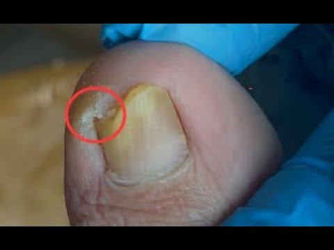Severe deformation toenails - YouTube