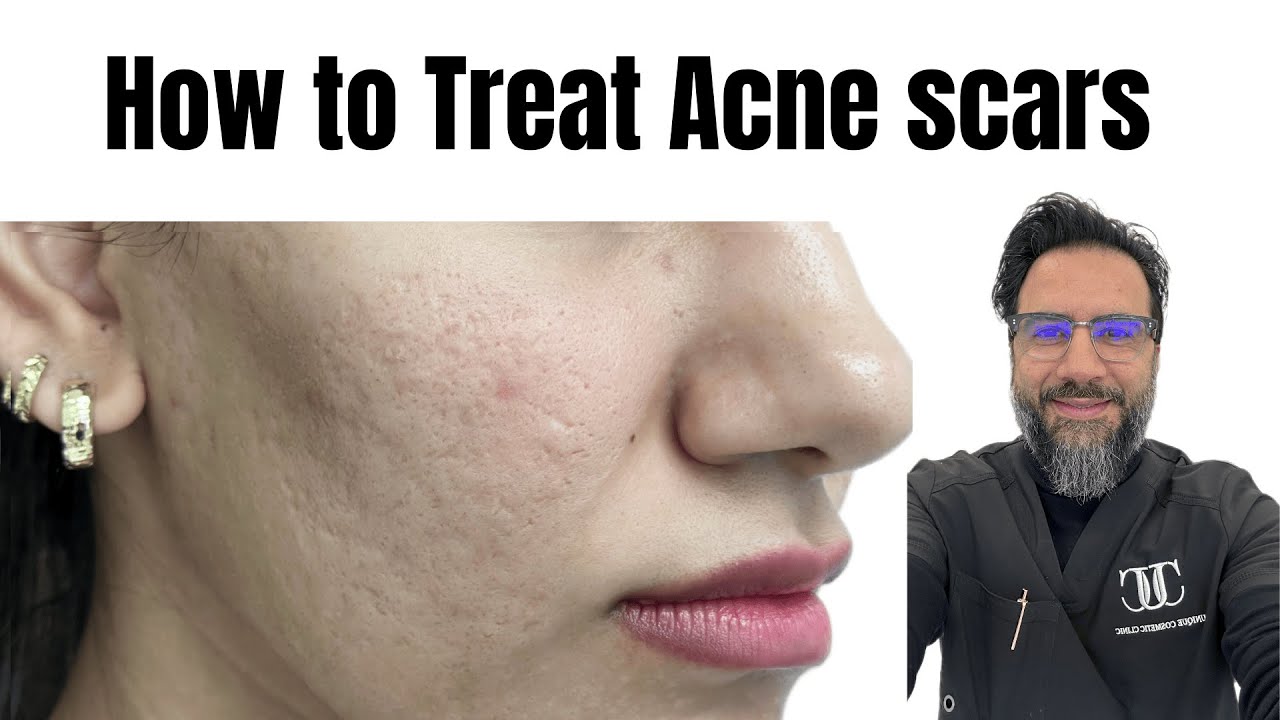 Complete Acne Scar Treatment Journey:TCA Cross, Halo & Profractional ...