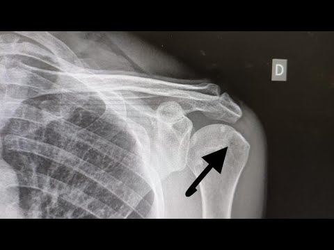 Fractura de troquíter: Volveremos más fuertes - YouTube