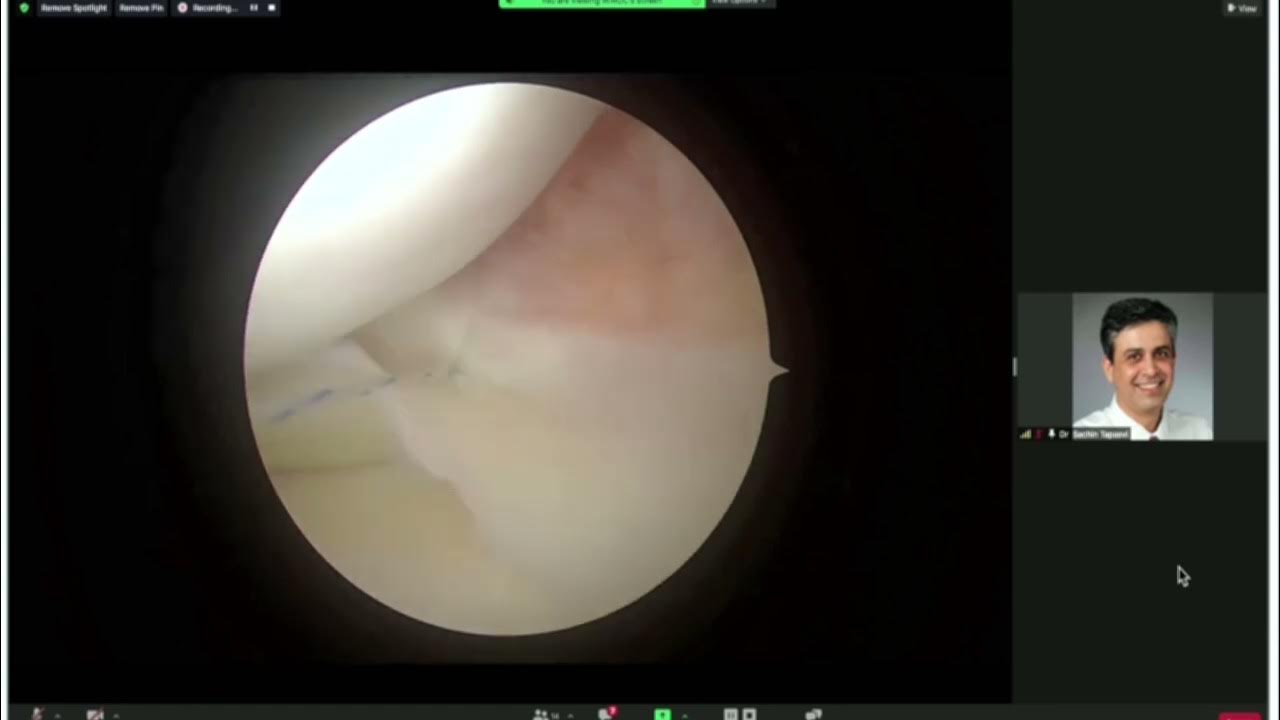 Meniscal Repair Dr Sachin Tapasvi - YouTube