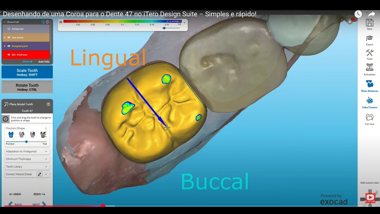 Designing a Crown for Tooth 47 in iTero Design Suite – Simple and Fast ...