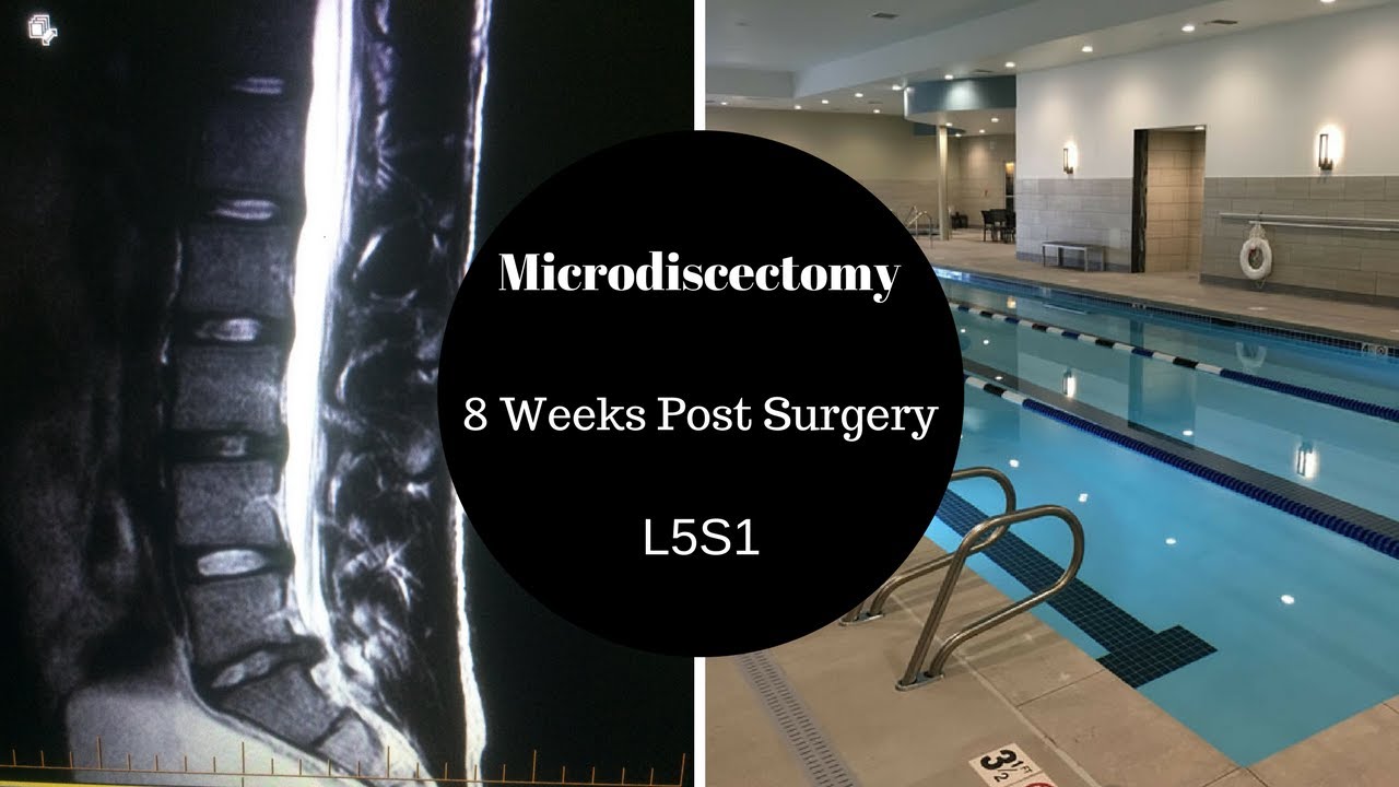 Microdiscectomy 2 Months Post Surgery (L5S1) - YouTube