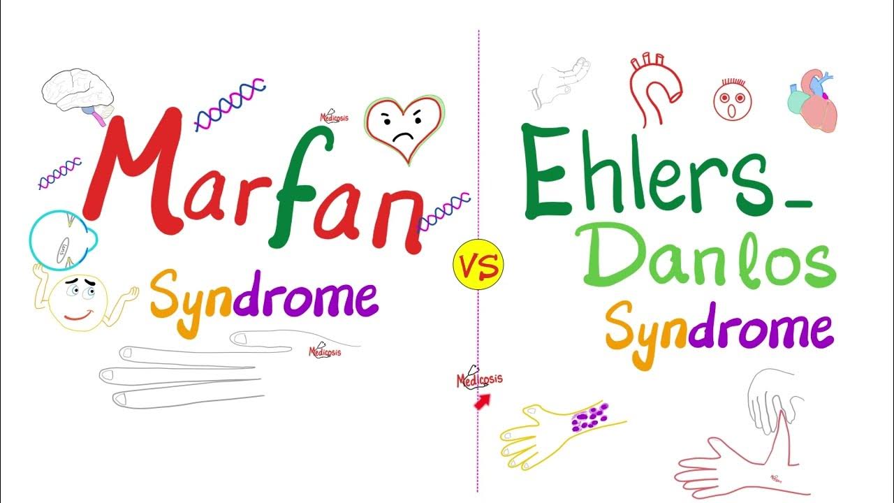 Marfan Syndrome Vs Ehlers Danlos Syndrome Youtube
