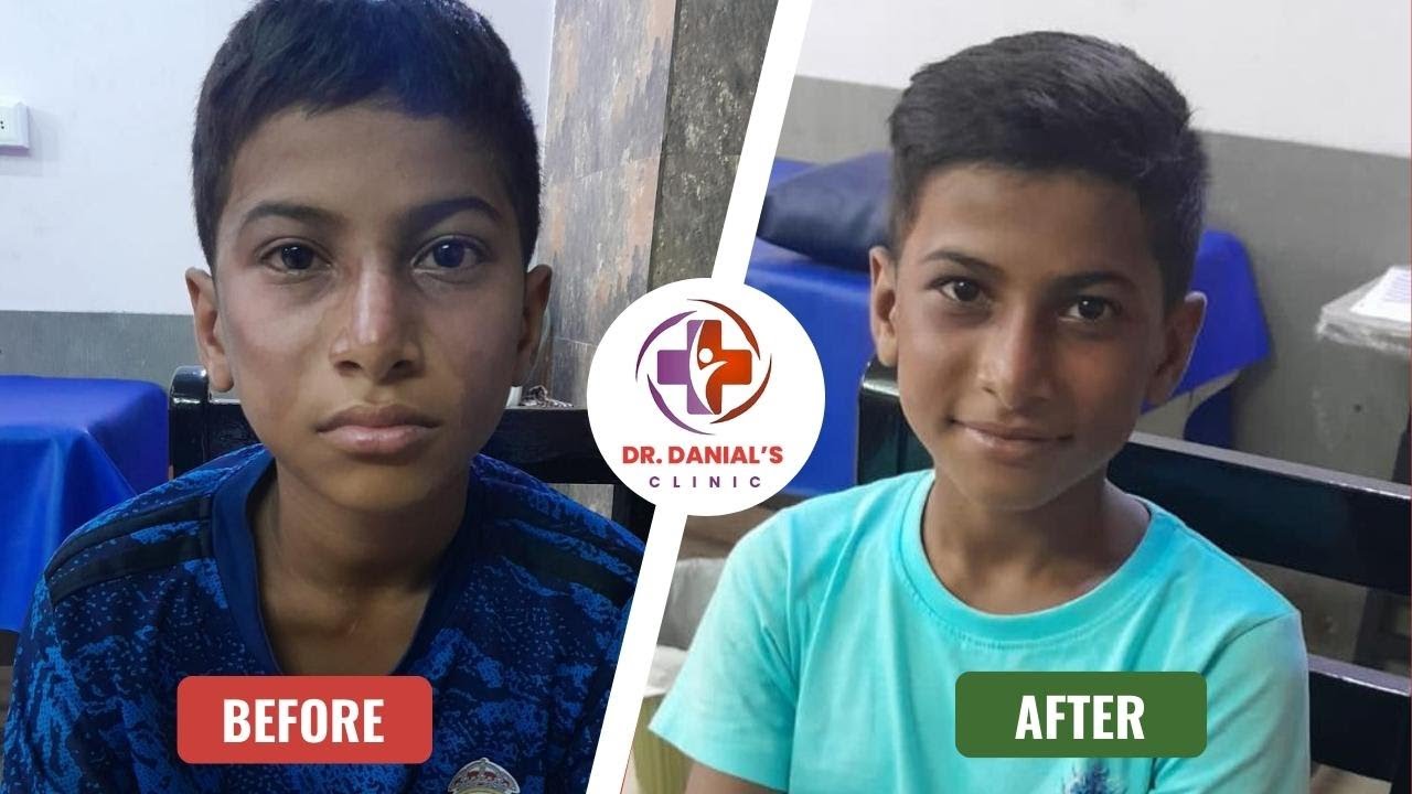Remarkable 2-Month Vitiligo Treatment Results for Kids | White Spot ...