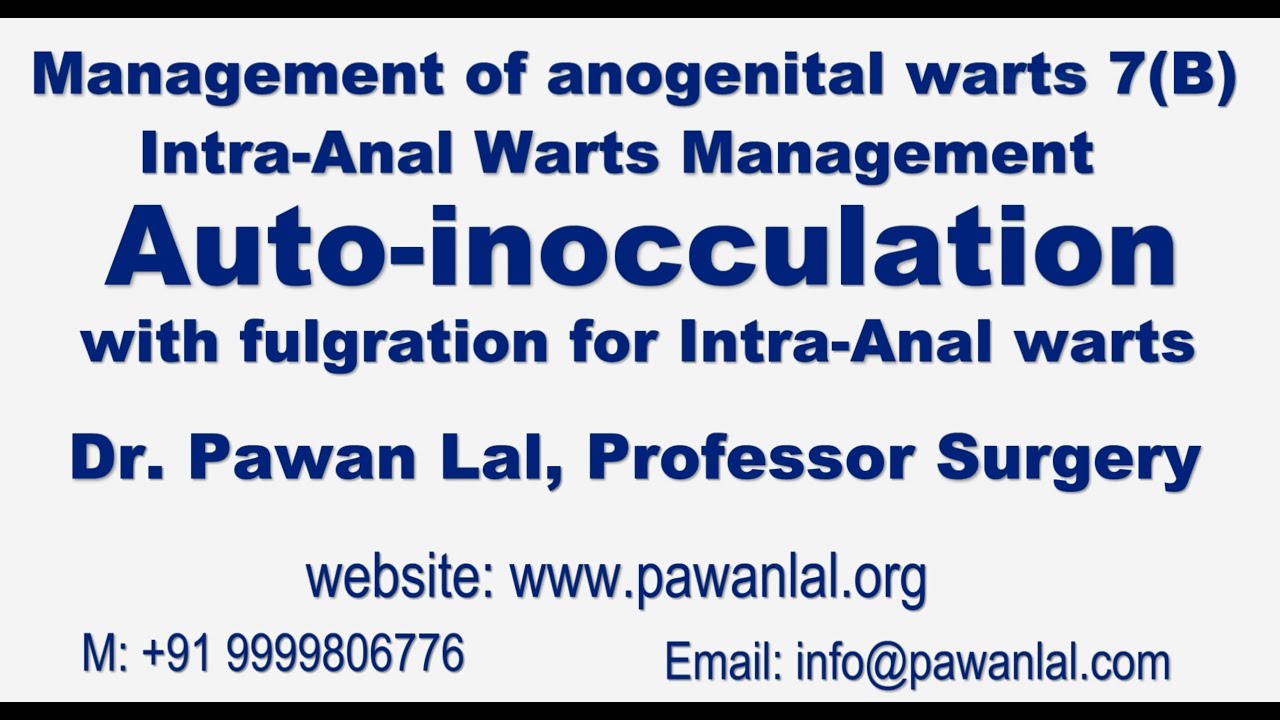 warts management gaint condyloma 7b intra anal warts - YouTube