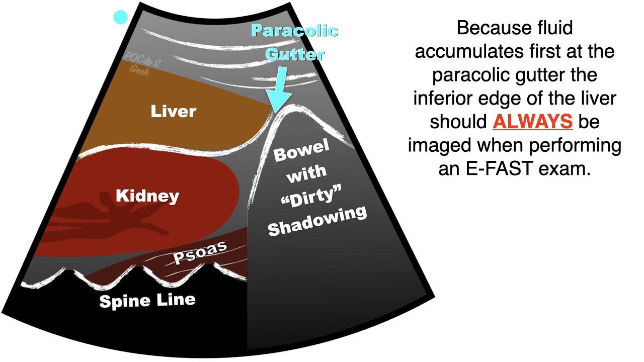POCUS: EFAST - Progression free fluid in the Right Upper Quadrant (RUQ ...