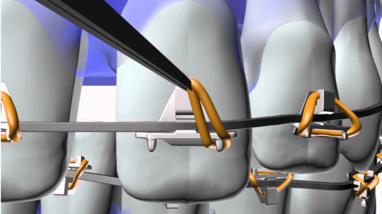 2 O Ring Placement - YouTube