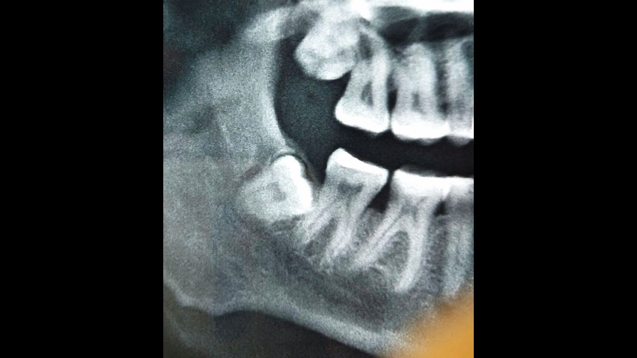 Impacted Molar Surgery - Mandibular third molar - YouTube