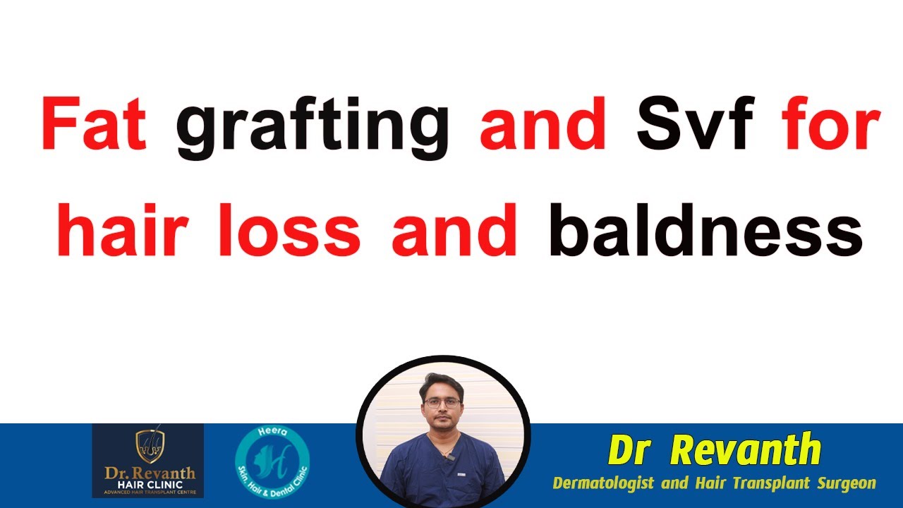 Fat grafting and Svf for hair loss and baldness || Dr Revanth - YouTube
