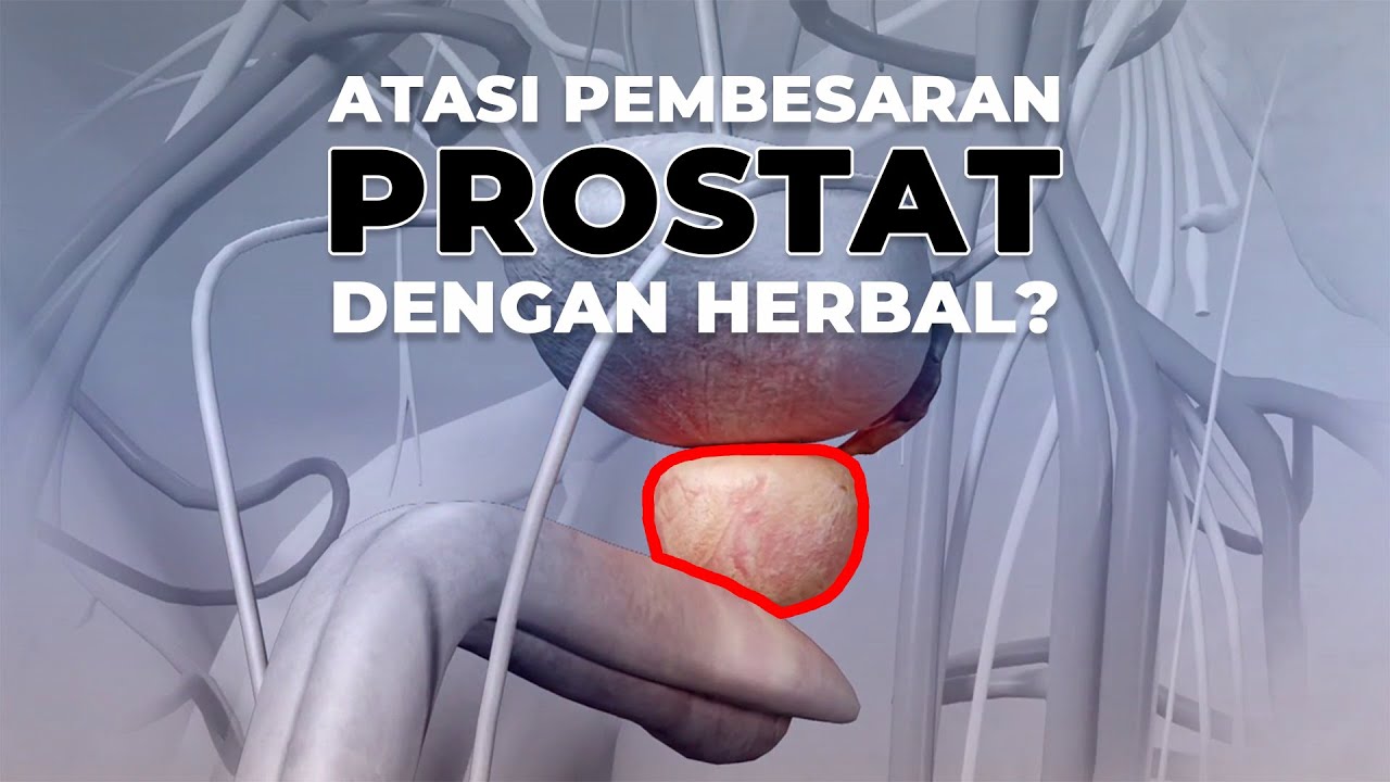 Efek samping operasi prostat TURP (Transurenthal Resection Prostate ...