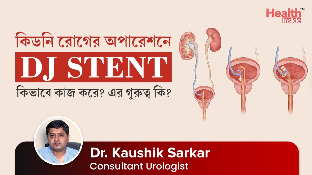 কিডনি রোগের অপারেশনে DJ stent এর গুরুত্ব কি? | Double J-stent in Kidney ...